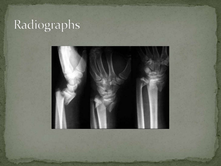 Smith’s fracture