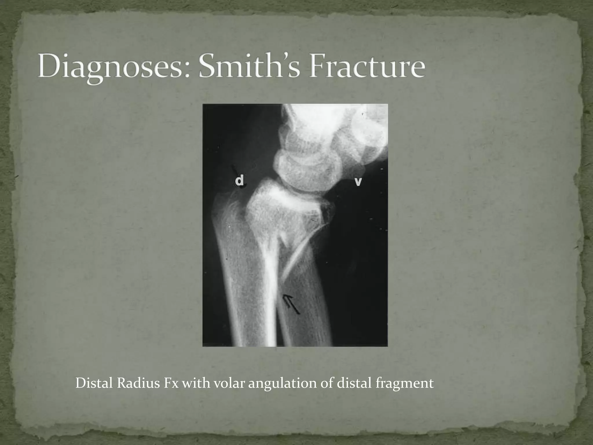 Smith’s fracture Power Point | PPTX