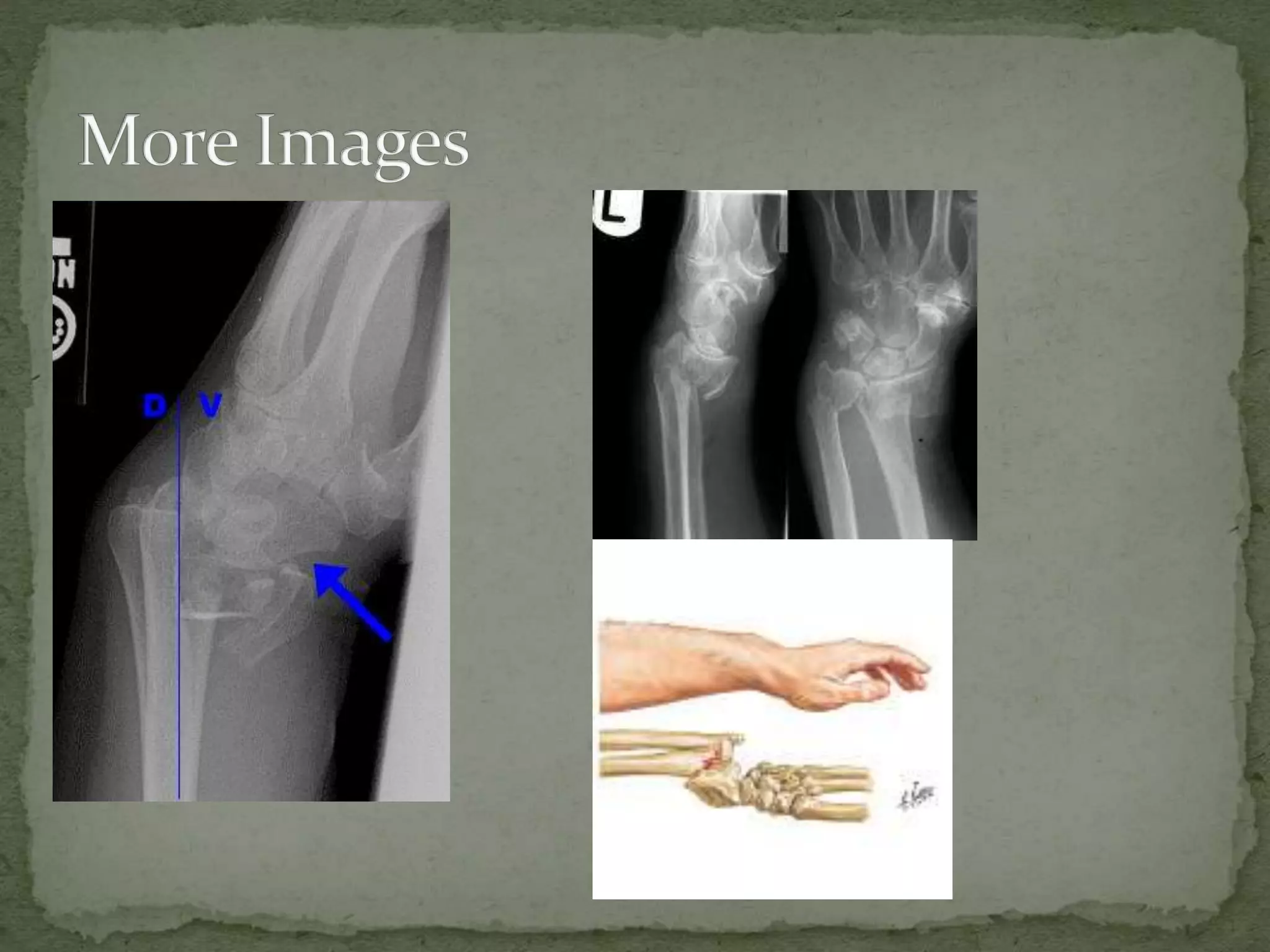 Smith’s fracture Power Point | PPTX