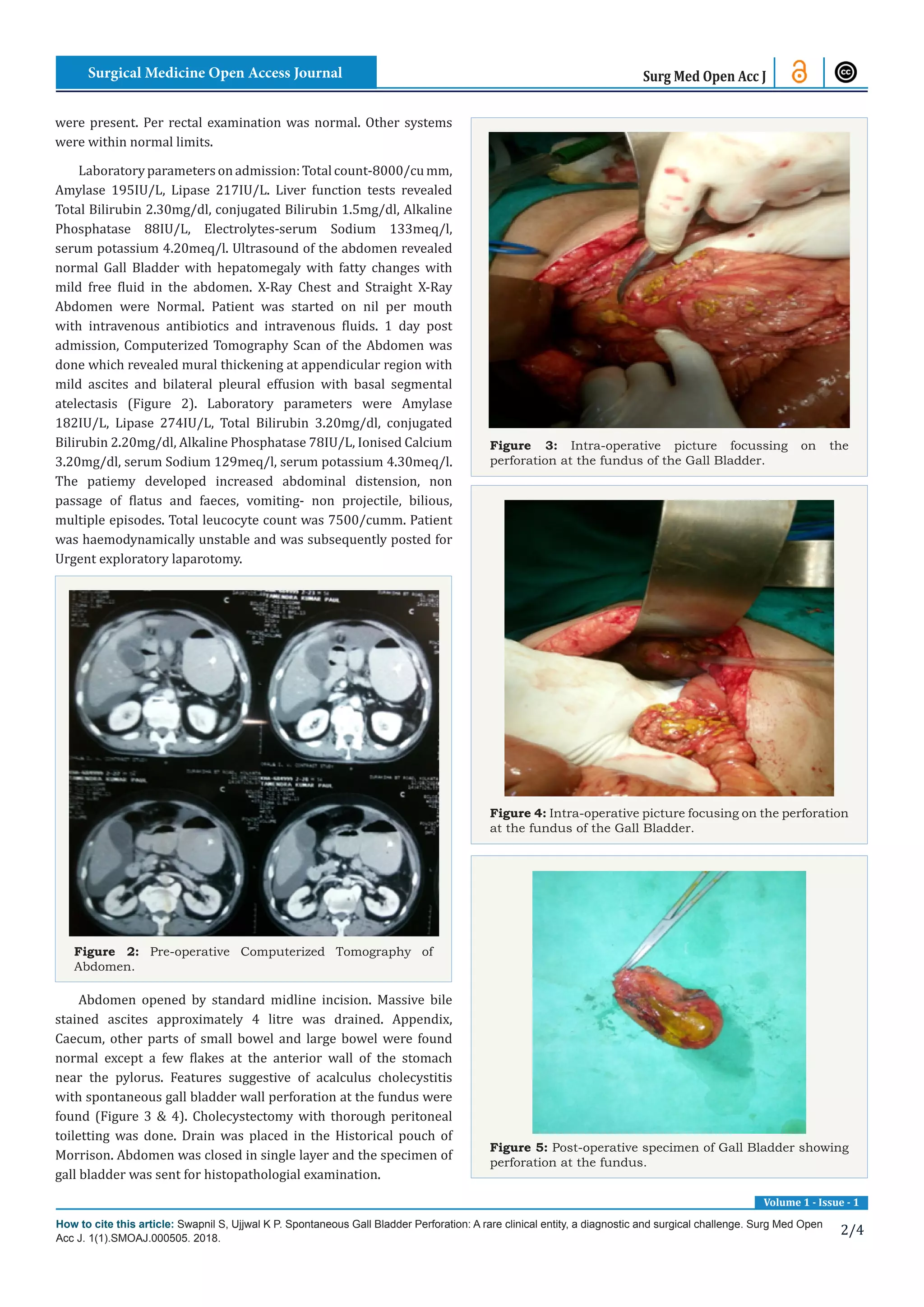 Spontaneous Gall Bladder Perforation: A rare clinical entity, a ...