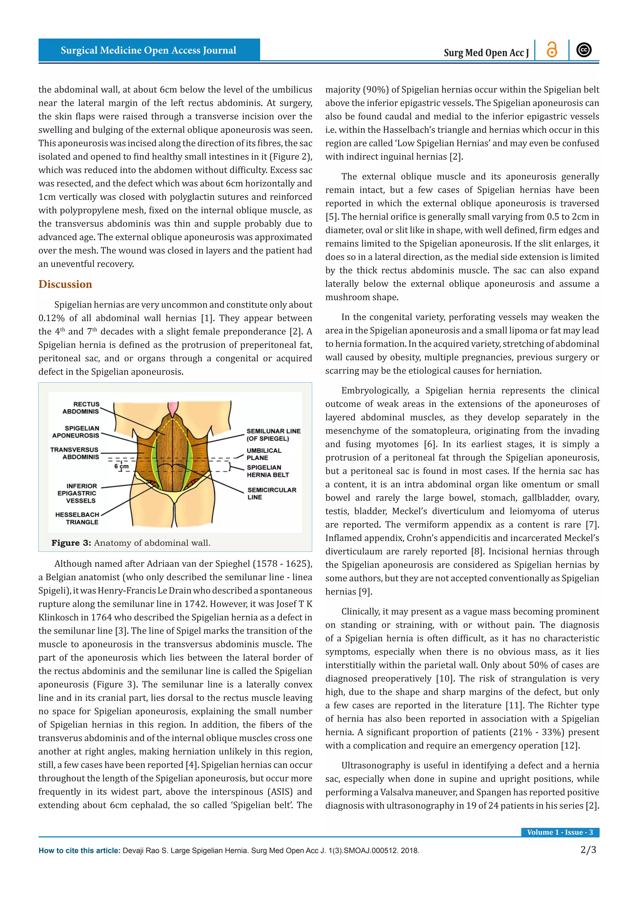 Large Spigelian Hernia | PDF