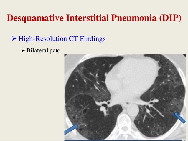 Smoking related interstitial lung diseases