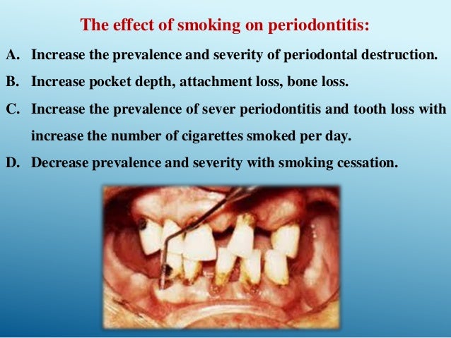 Smoking and periodontal disease Smoking and periodontal disease