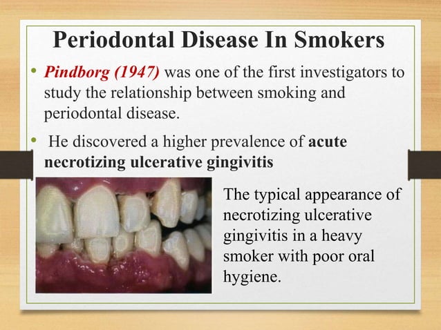 Smoking and Periodontal Disease presentation | PPTX | Illegal Drugs ...
