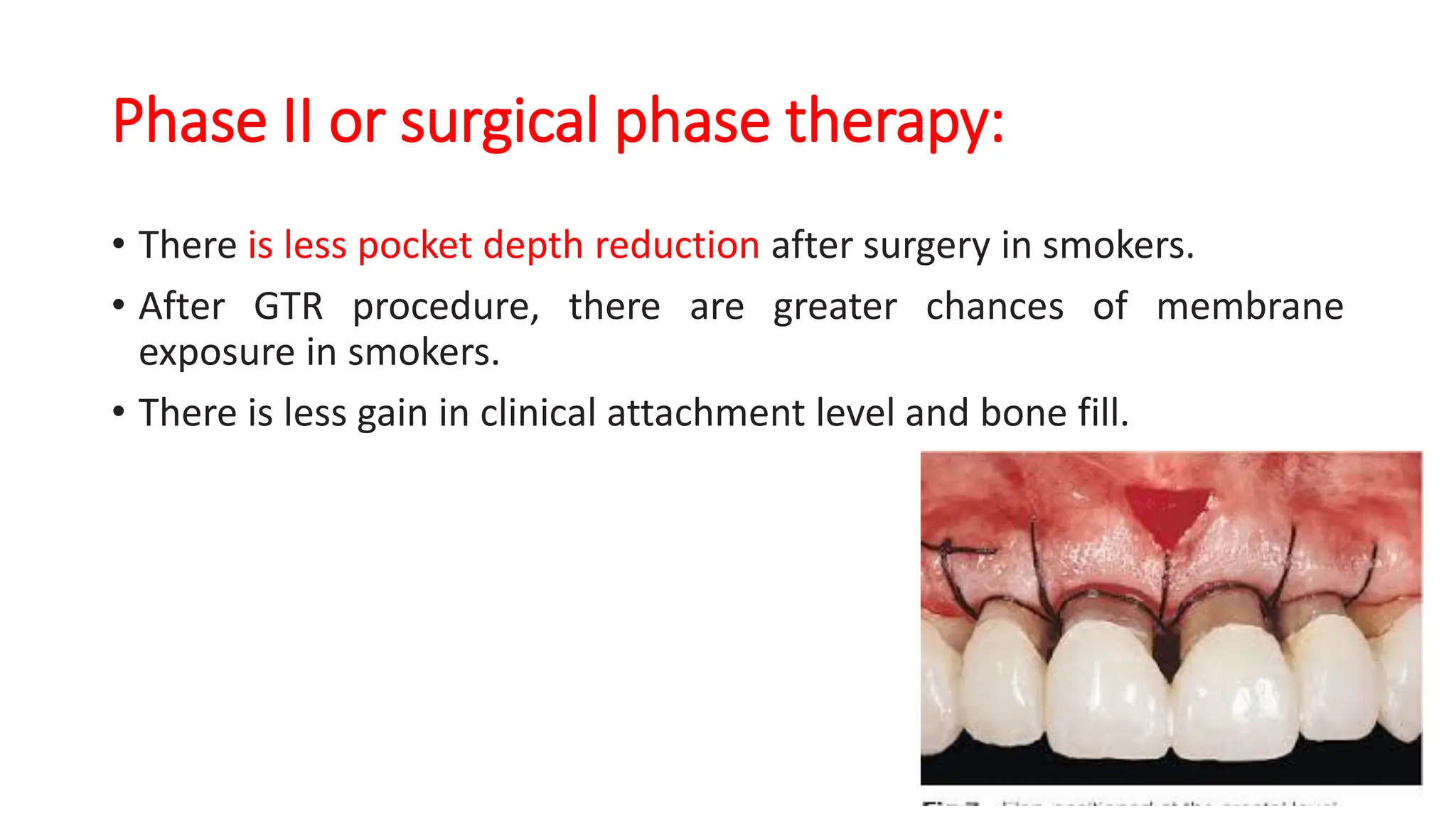 Smoking and periodontal disease (1).pdf in periodontal dentistry | PDF