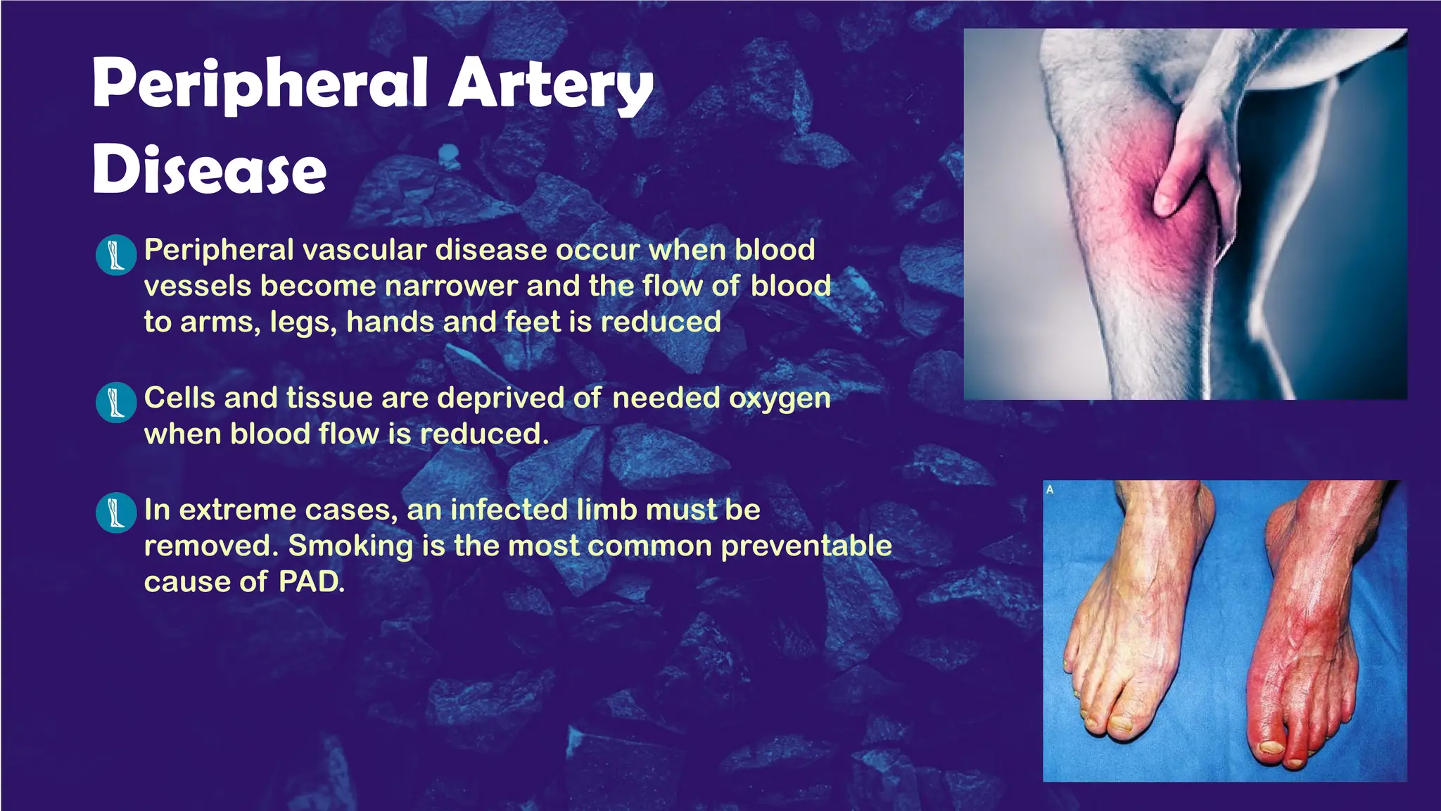 Smoking and its effect on cardiovascular system | PPTX