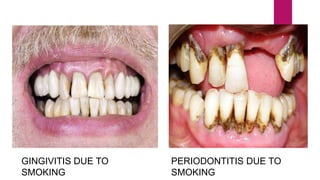 Smoking_PERIO .pptx