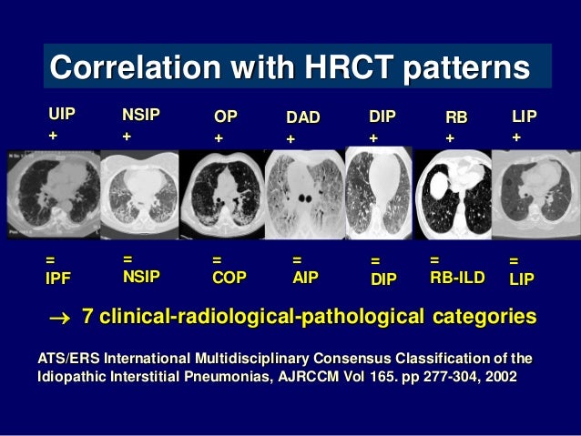 Smoking Related Interstitial Lung Diseases