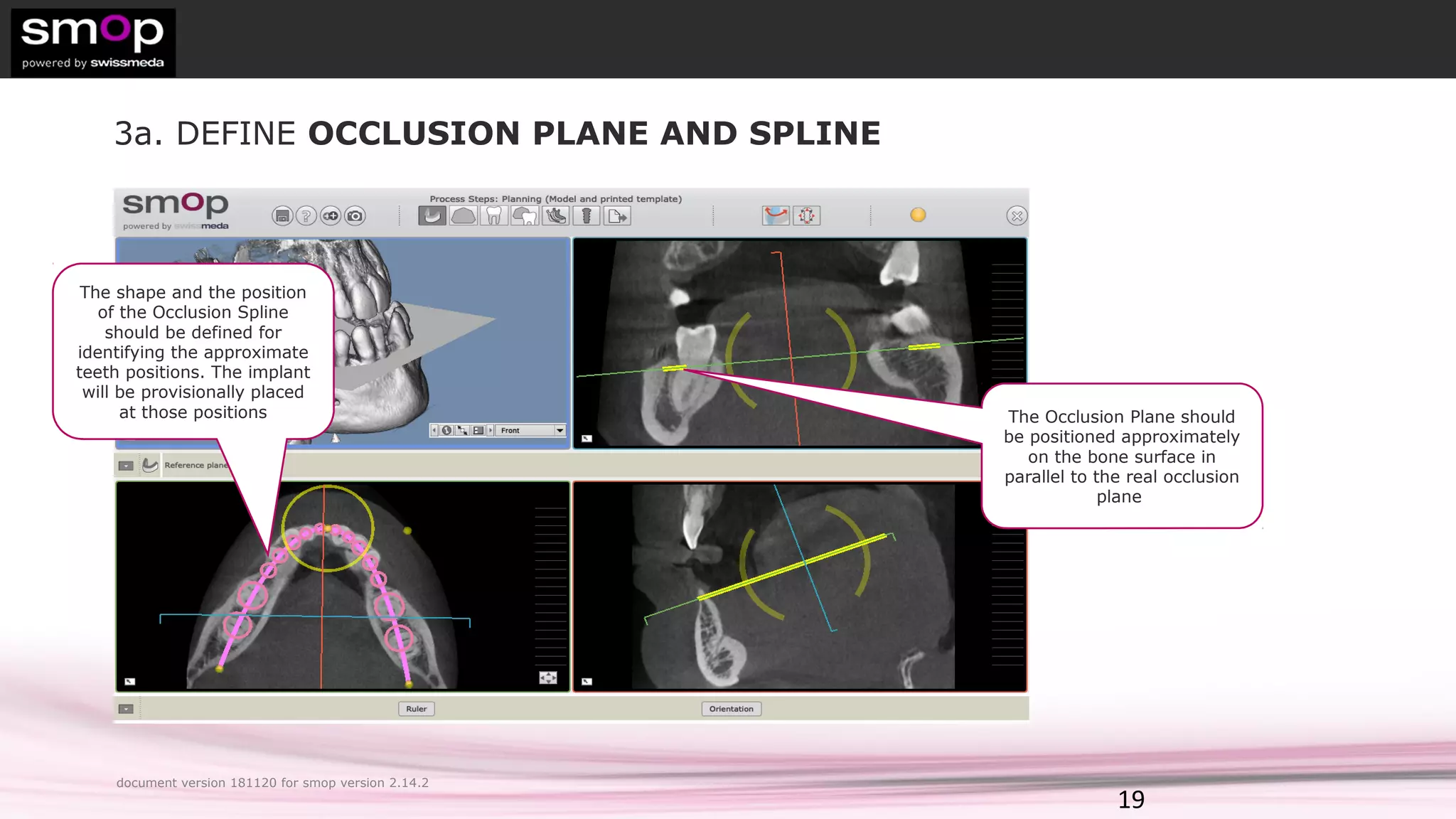 SMoP Guided Surgery Solution | PPT