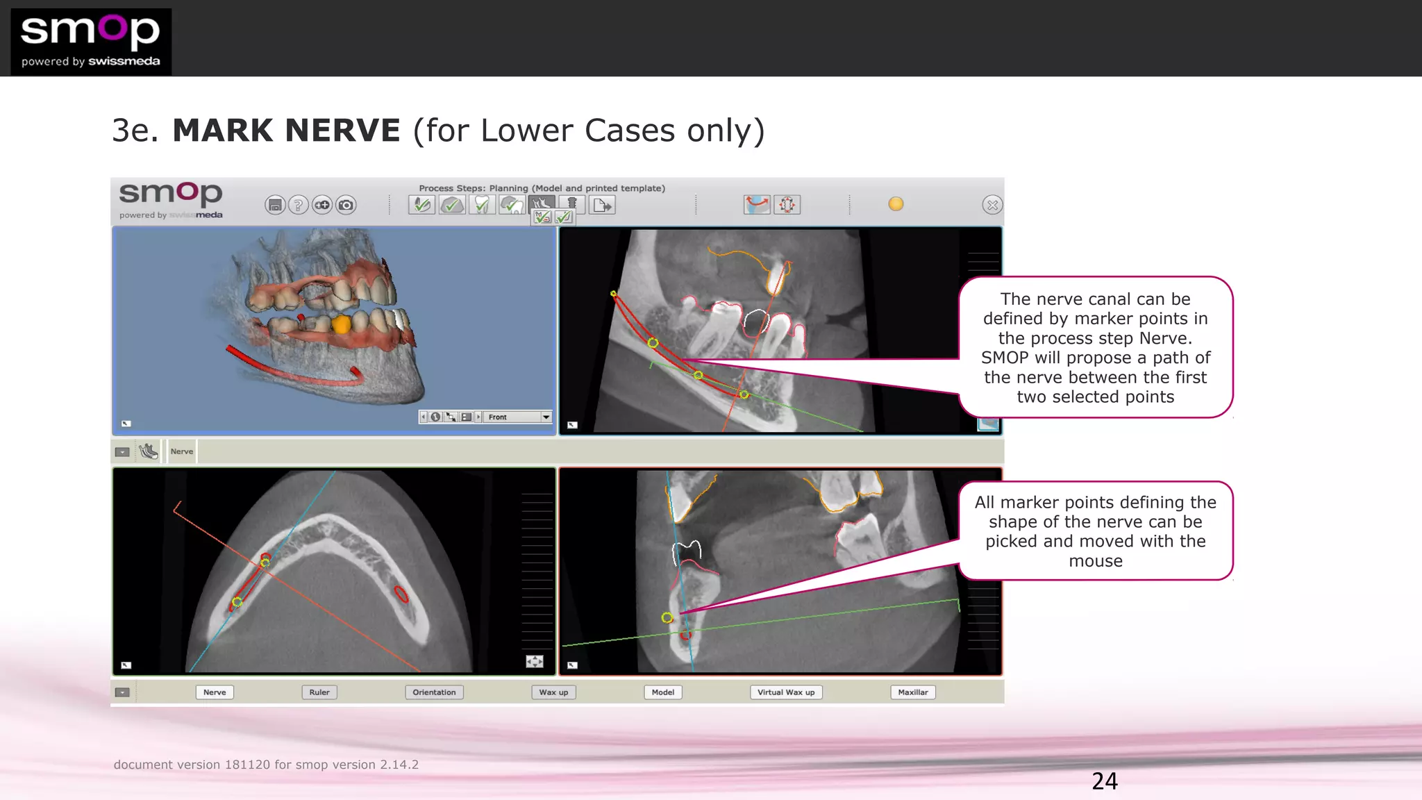 SMoP Guided Surgery Solution | PPT