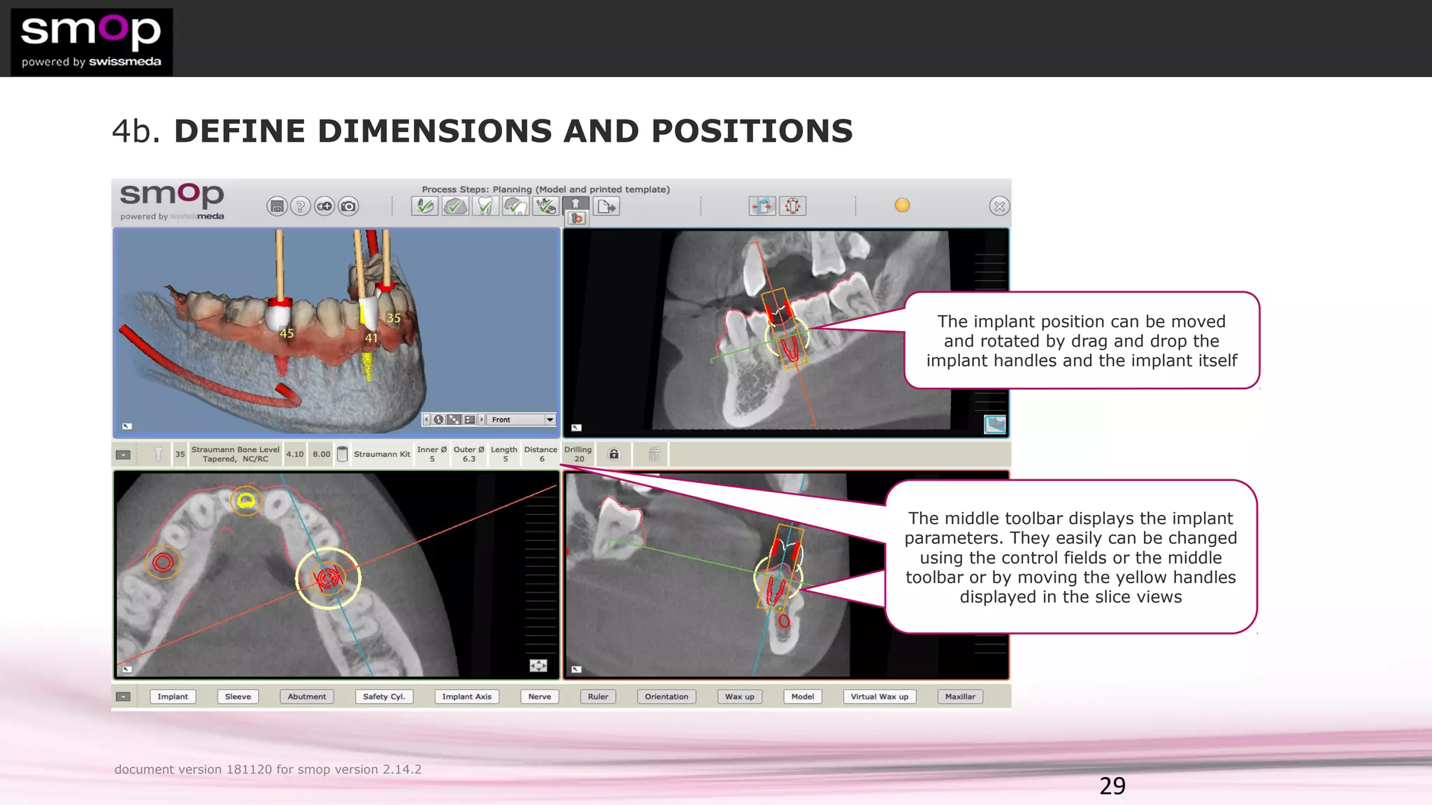 SMoP Guided Surgery Solution | PPT
