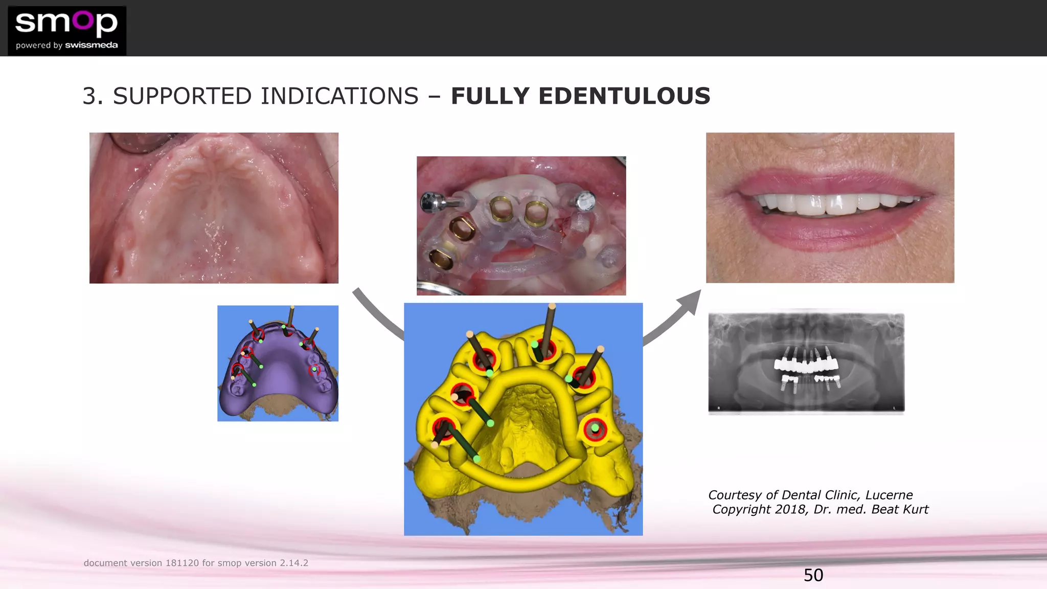 SMoP Guided Surgery Solution | PPT