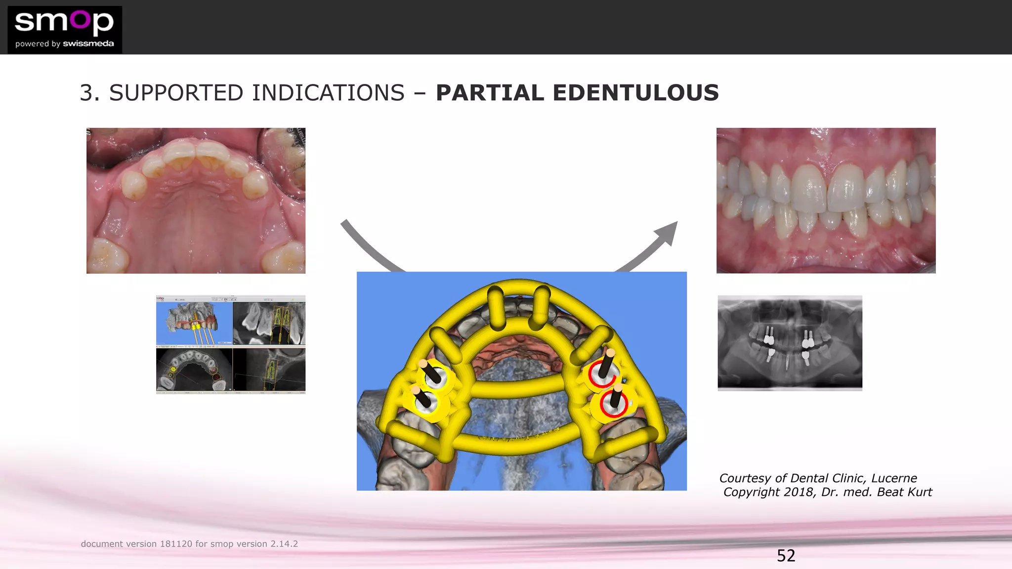 SMoP Guided Surgery Solution | PPT