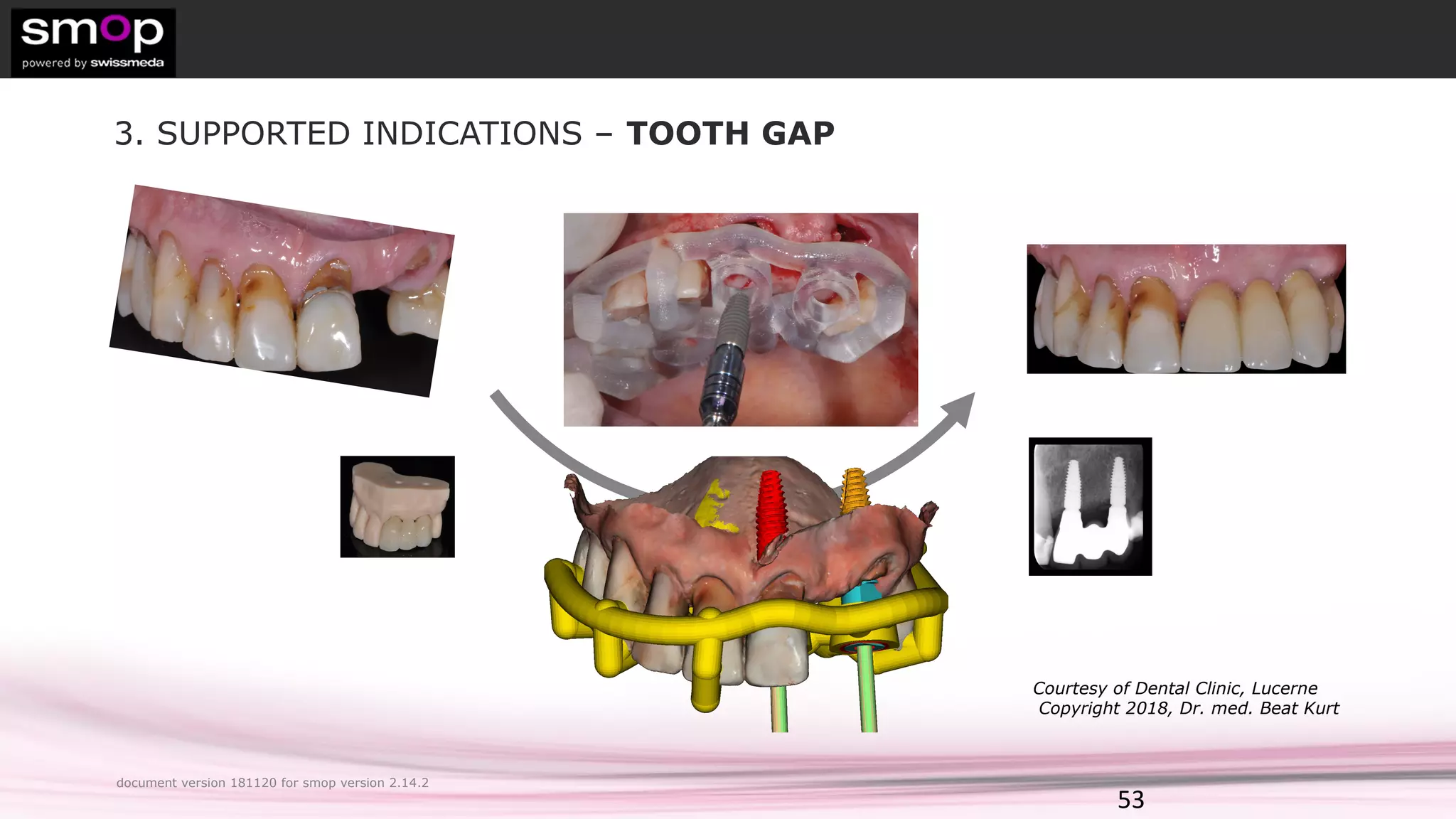 SMoP Guided Surgery Solution | PPT