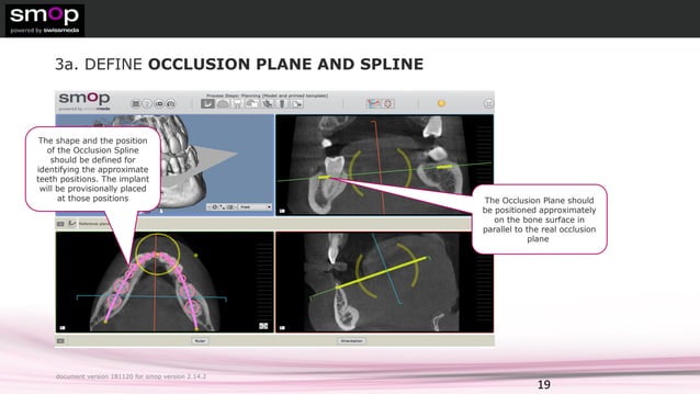 SMoP Guided Surgery Solution | PPT