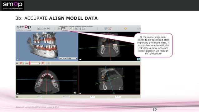 SMoP Guided Surgery Solution | PPT