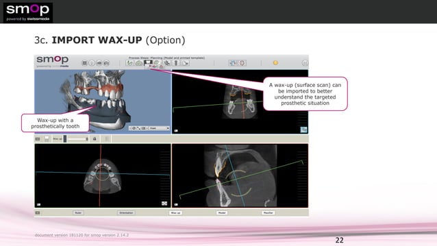 SMoP Guided Surgery Solution | PPT