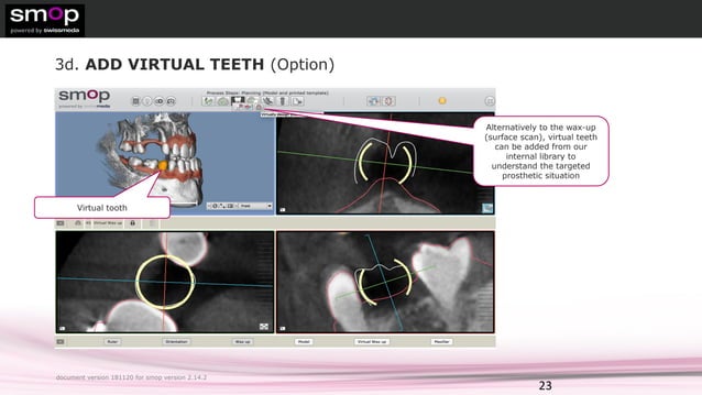 SMoP Guided Surgery Solution | PPT