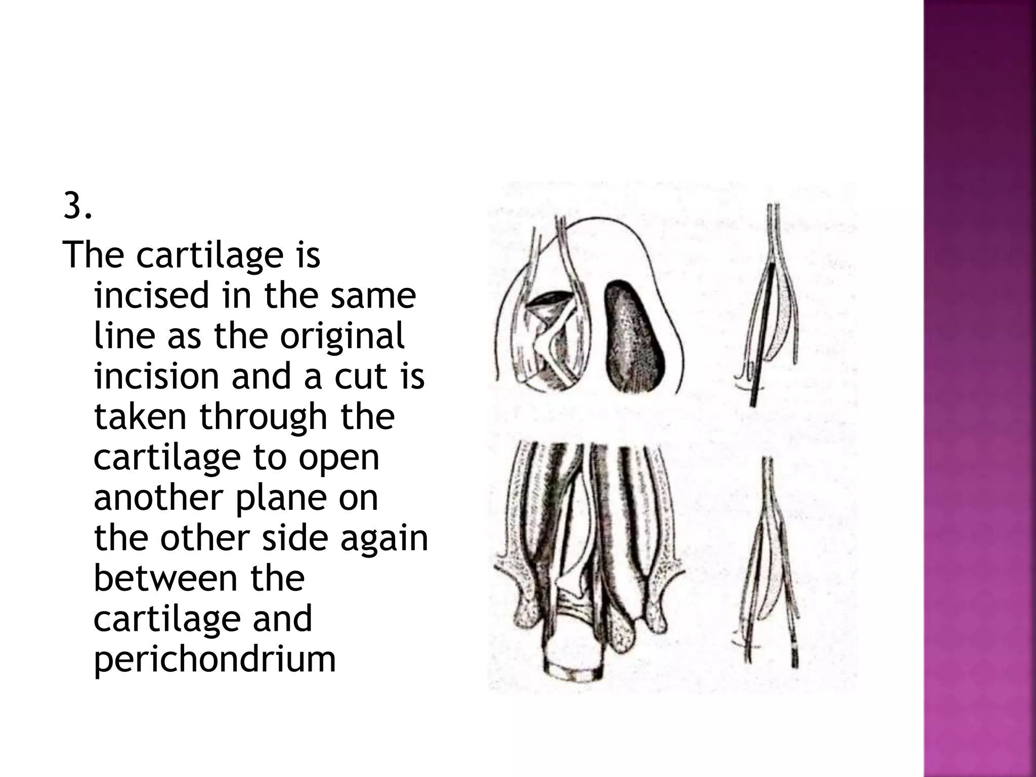 Smr and septoplasty | PPTX