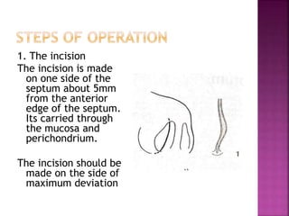 Septoplasty Procedure Steps