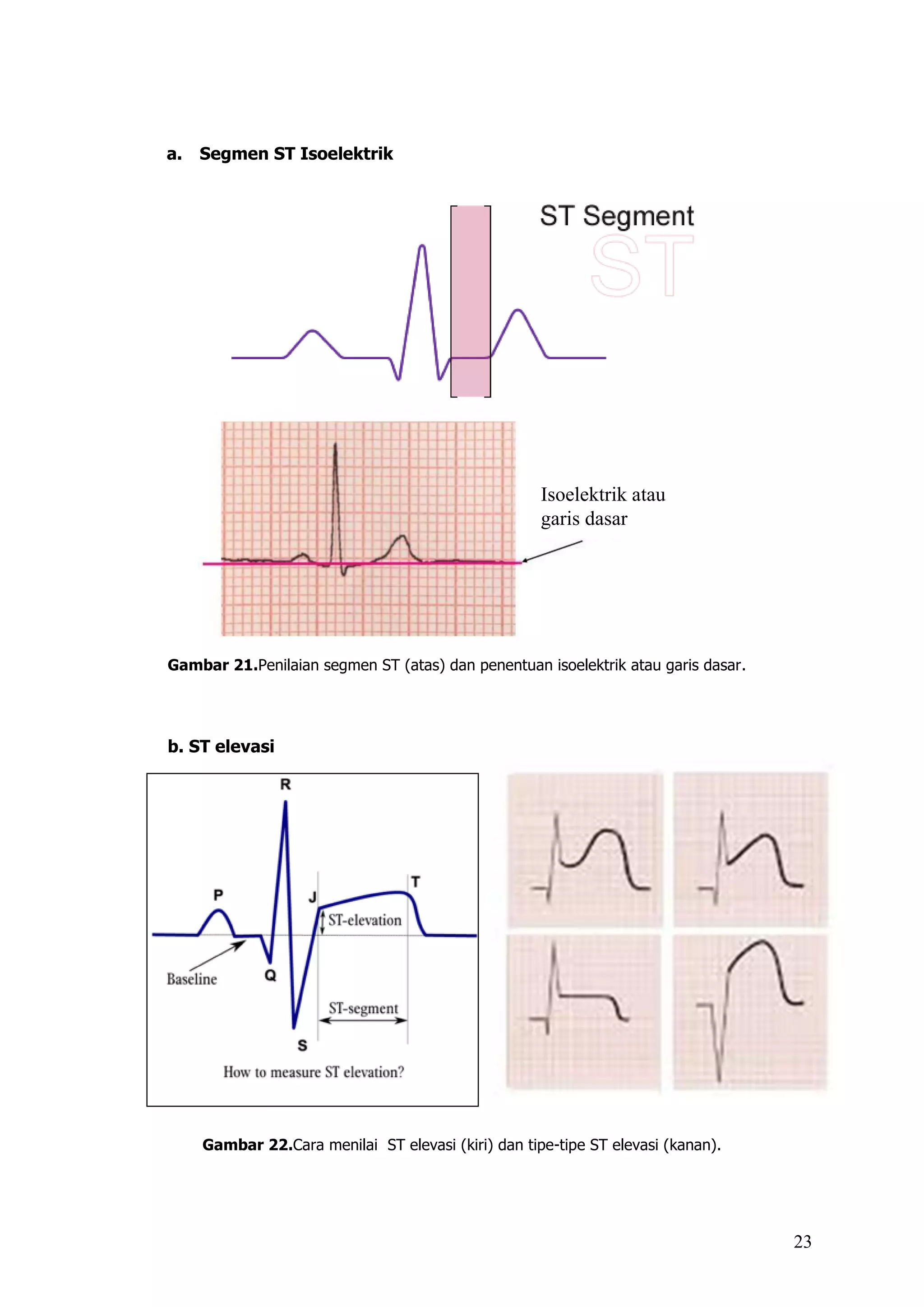 smt-4-Interpretasi-EKG.pdf