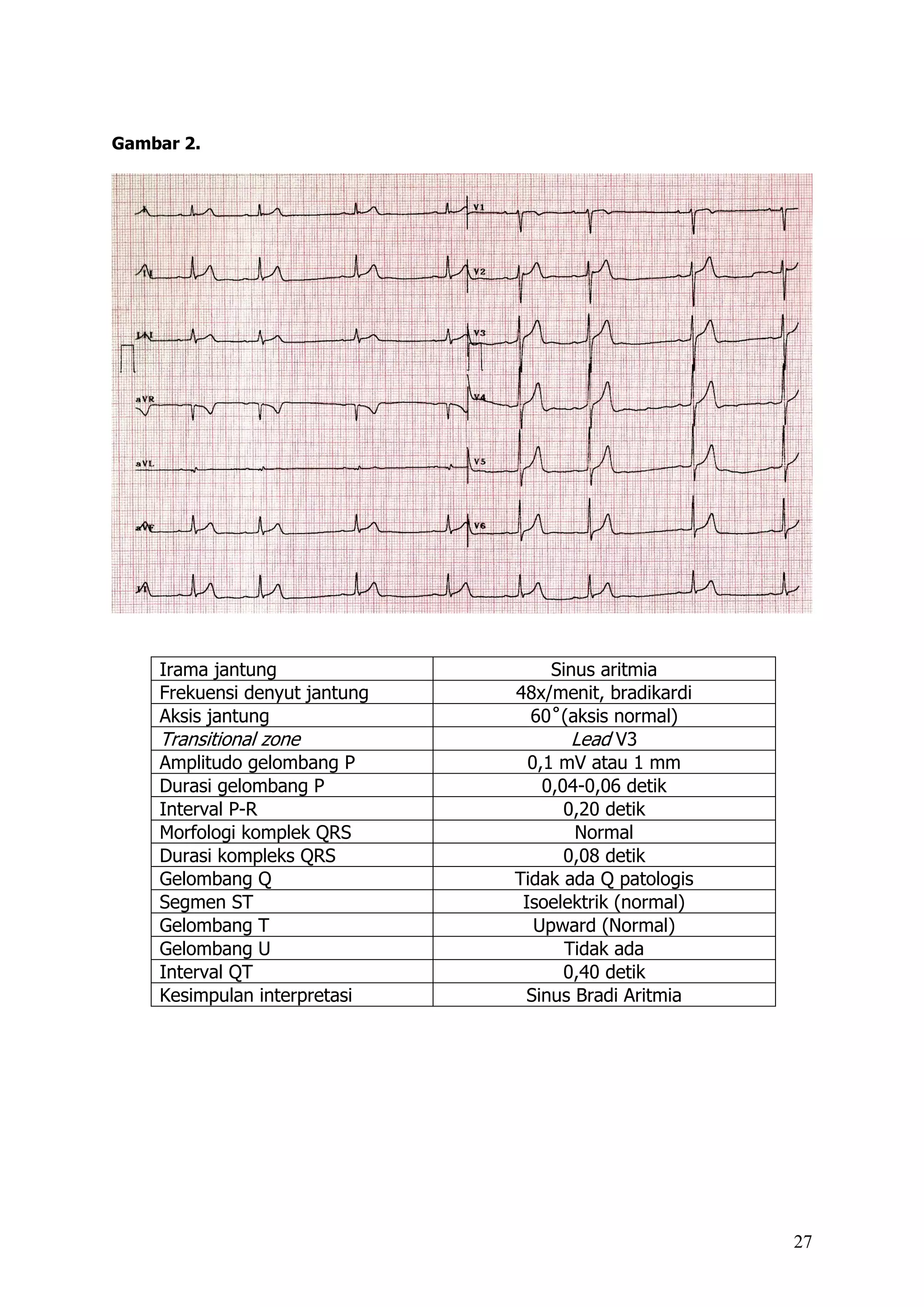 smt-4-Interpretasi-EKG.pdf