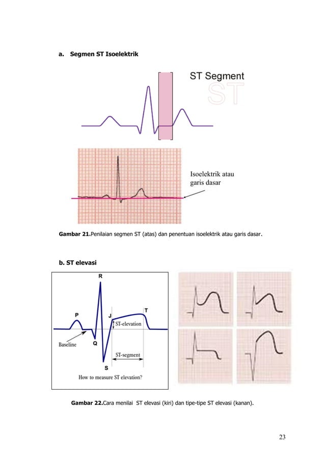 smt-4-Interpretasi-EKG.pdf