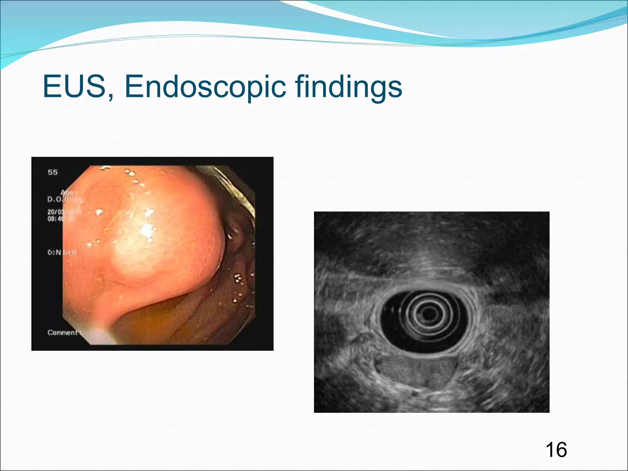 Clinical, endoscopic imaging and the value of endoscopic biopsy by ...