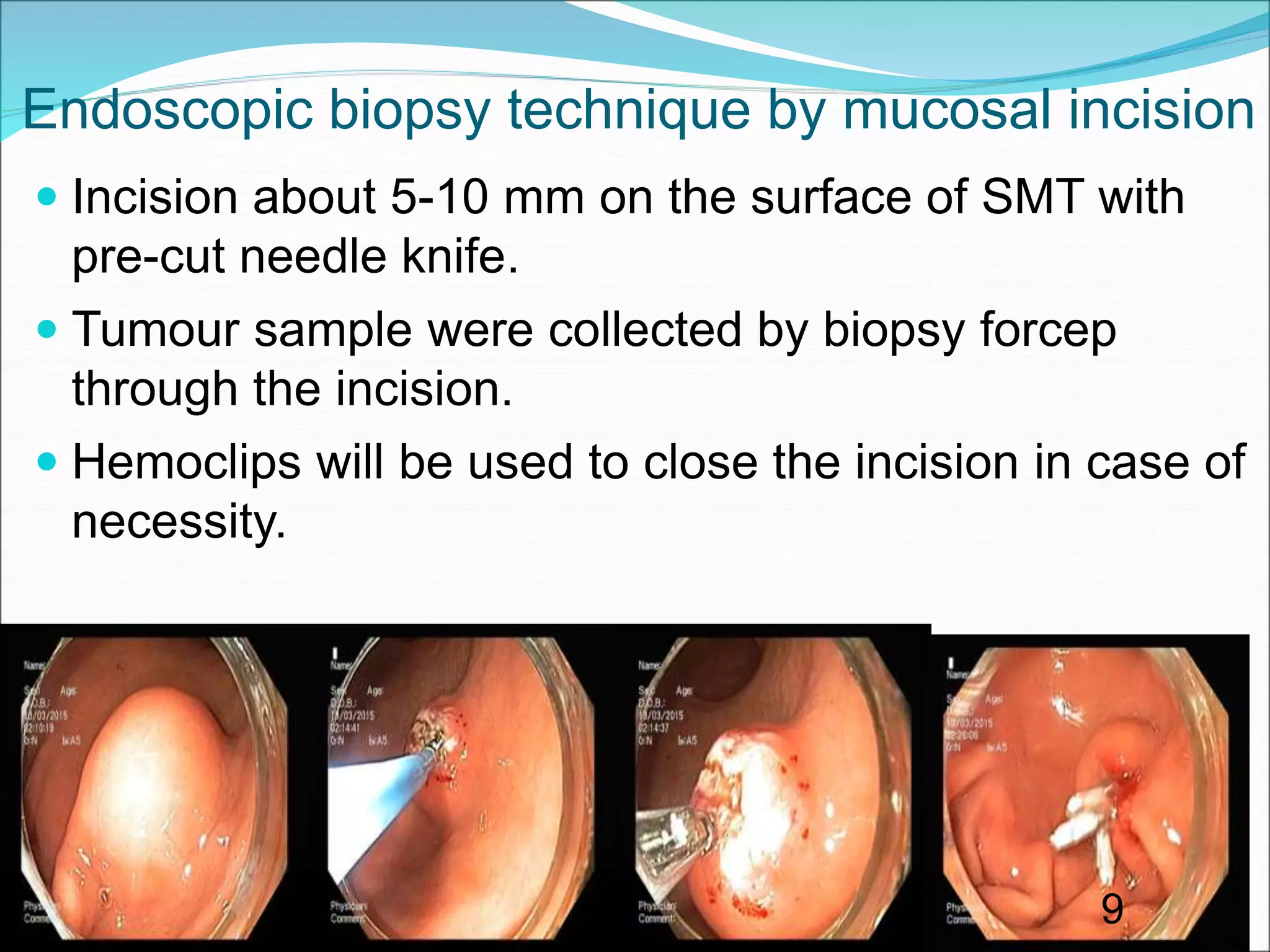 Clinical, endoscopic imaging and the value of endoscopic biopsy by ...
