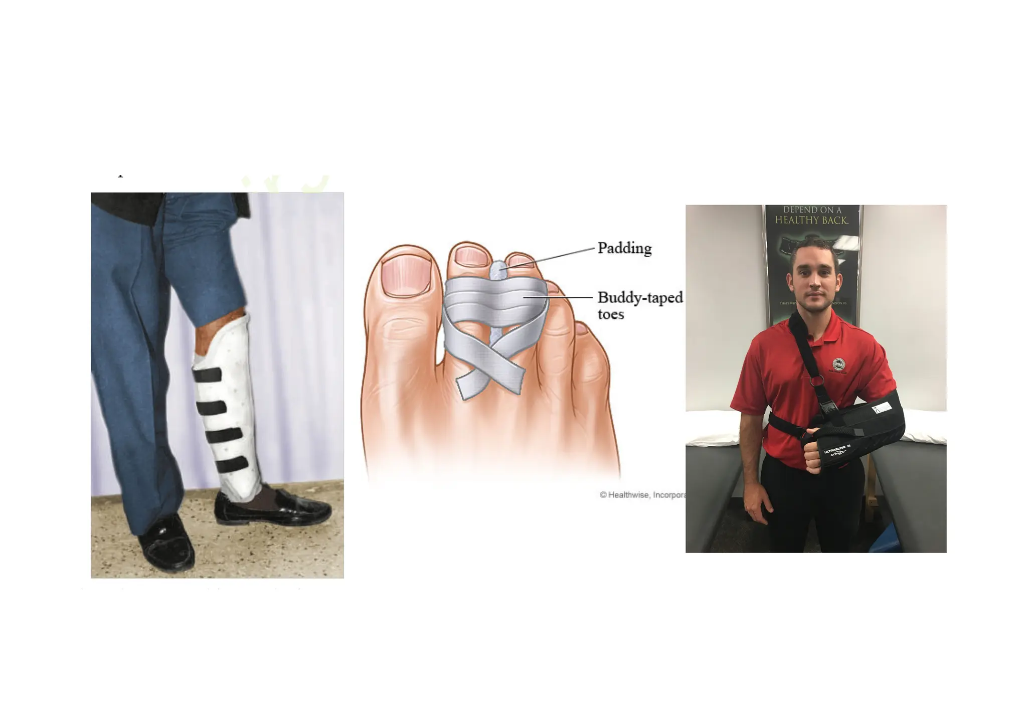 Definitive management of Closed Fracture and Management of Open ...