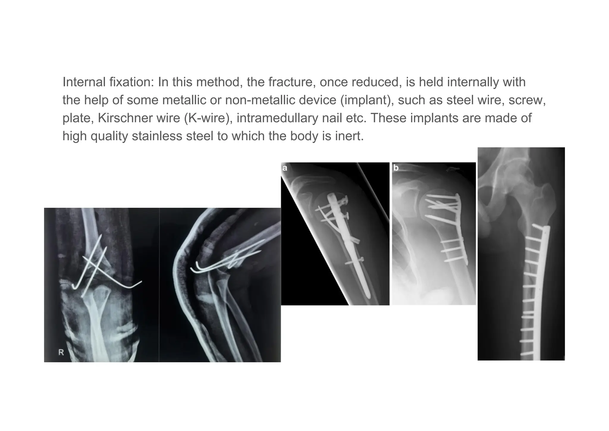 Definitive management of Closed Fracture and Management of Open ...