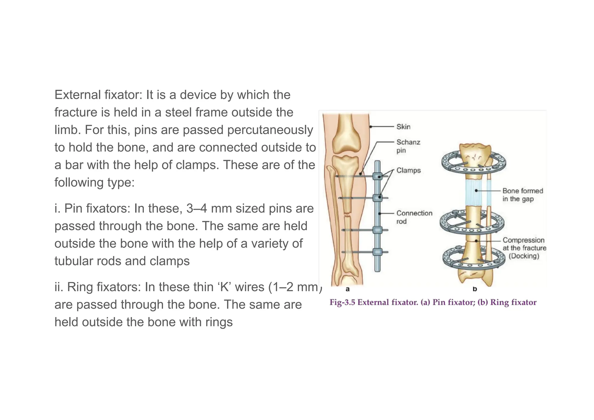 Definitive management of Closed Fracture and Management of Open ...