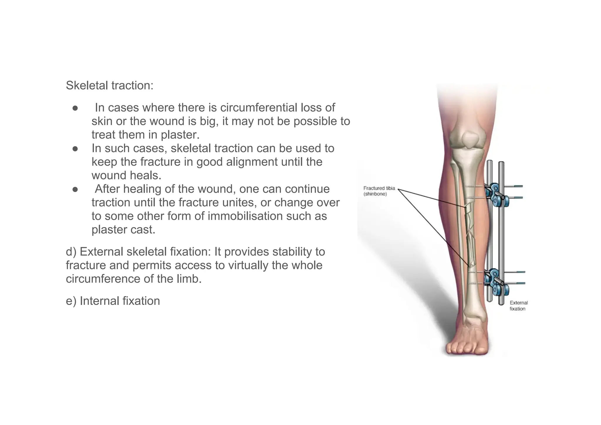 Definitive management of Closed Fracture and Management of Open ...