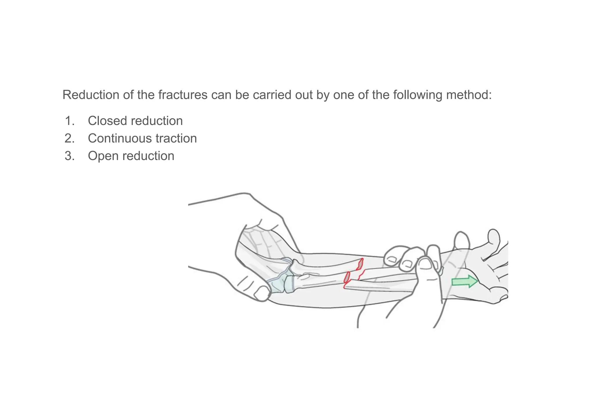 Definitive management of Closed Fracture and Management of Open ...