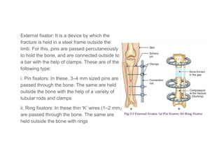 Definitive management of Closed Fracture and Management of Open ...
