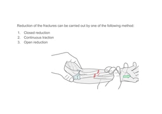 Definitive management of Closed Fracture and Management of Open ...