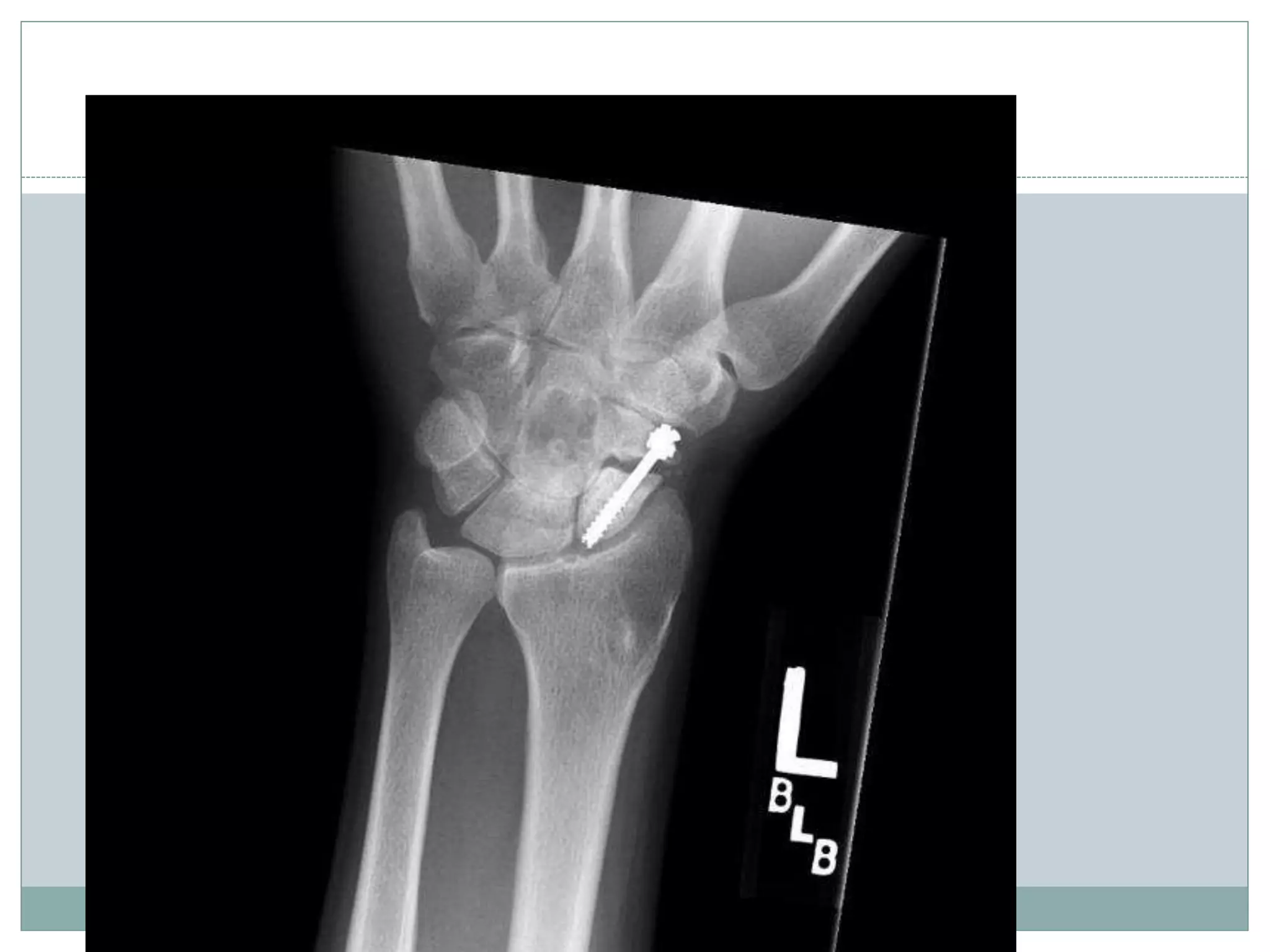 SLAC & SNAC WRIST | PPTX