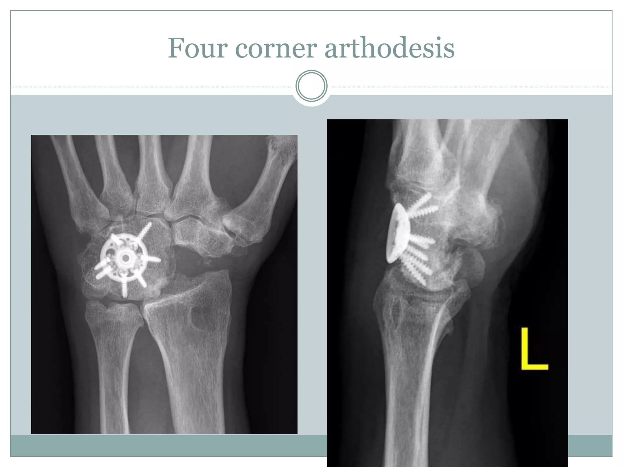 SLAC & SNAC WRIST | PPTX