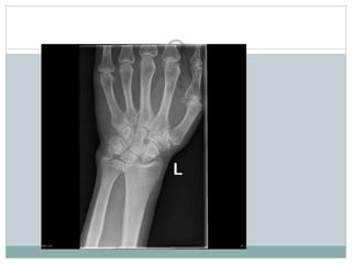 SLAC & SNAC WRIST | PPTX