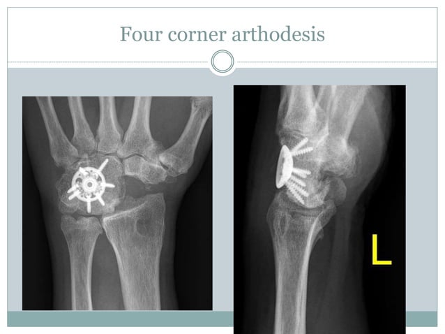 SLAC & SNAC WRIST | PPT