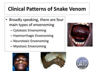 Snakebite in Zimbabwe: An Overview of Snake Antivenon | PPTX