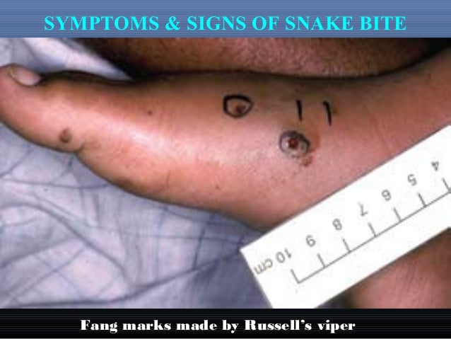 Snake bite management in Pediatrics – DR. TRYNAADH