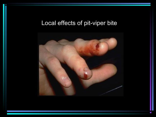 Snakebite | PPT | First Aid | Injuries