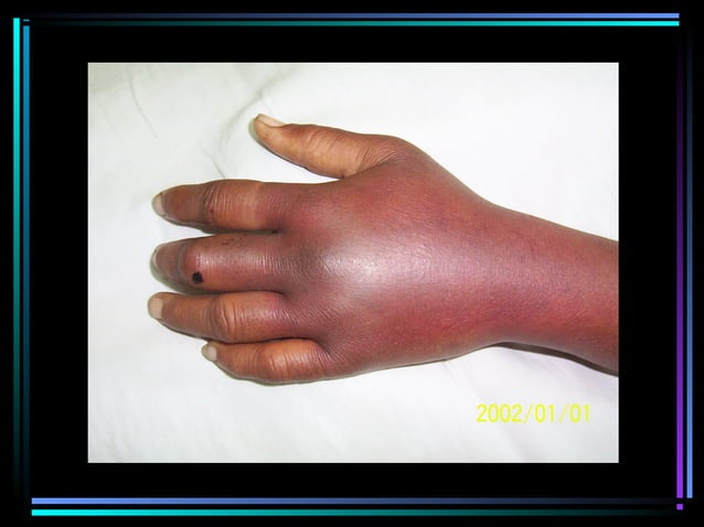 Snakebite | PPT | First Aid | Injuries