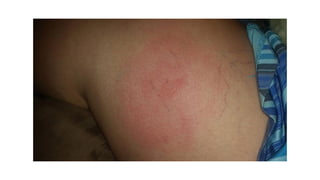 Snake bite .. scorpion sting | PDF