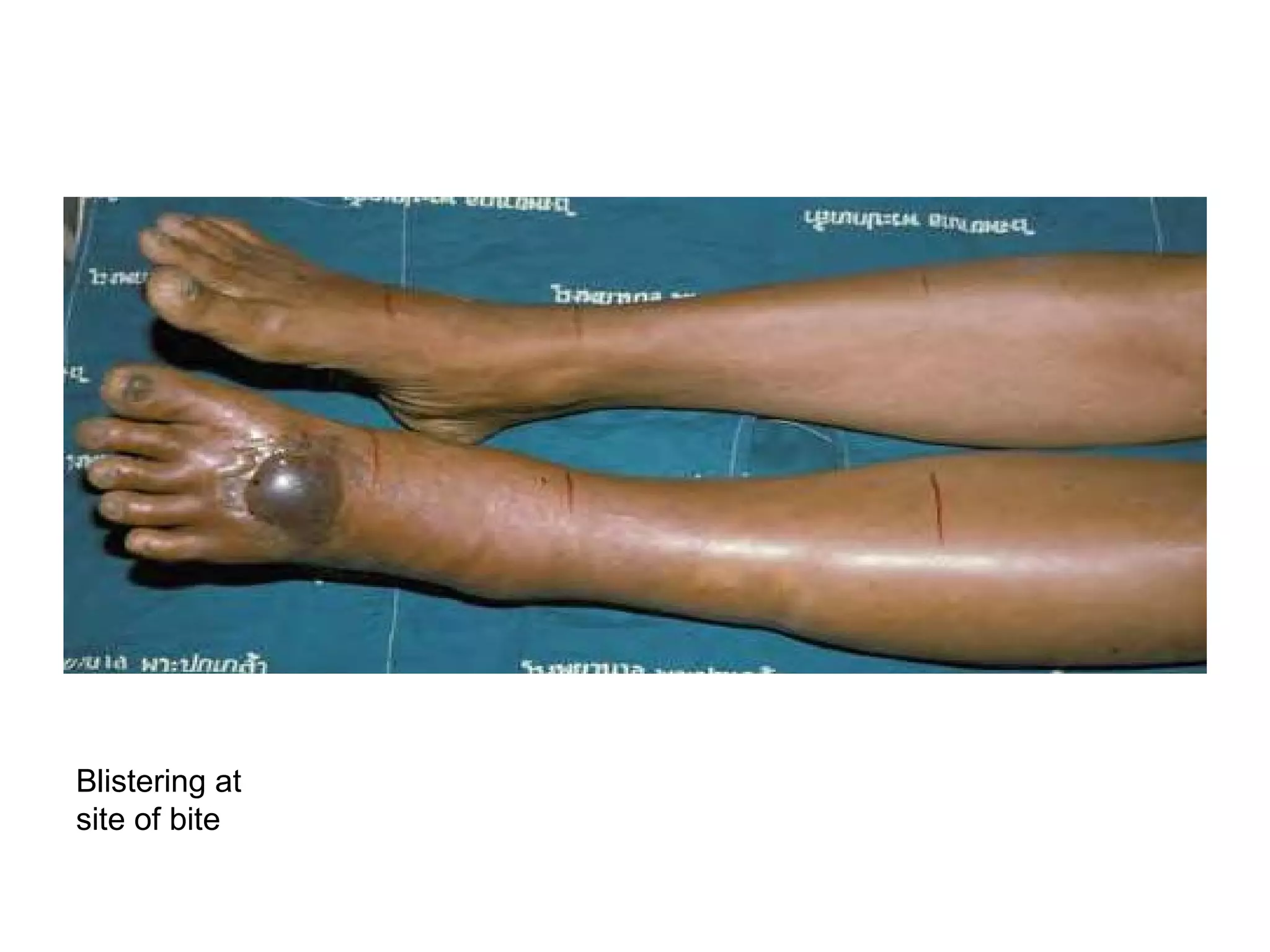 Snake bite in pediatrics | PPT