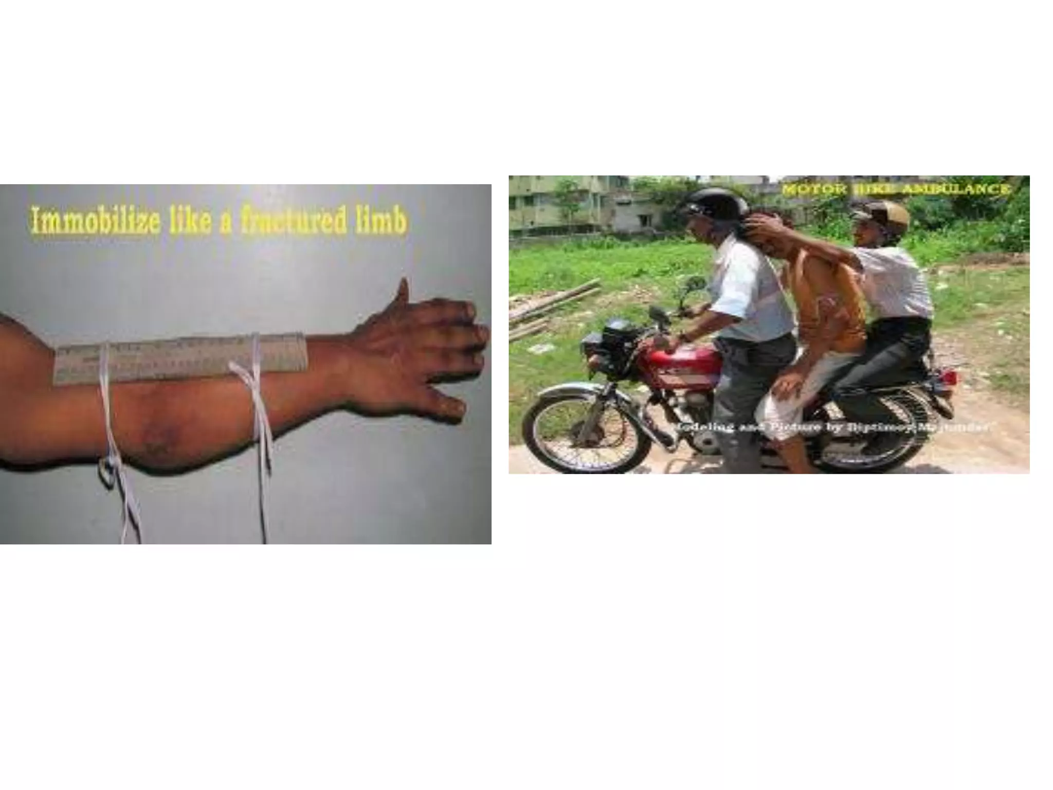 Snake bite - ASV Protocols and Management - Antisnake Venom | PPTX