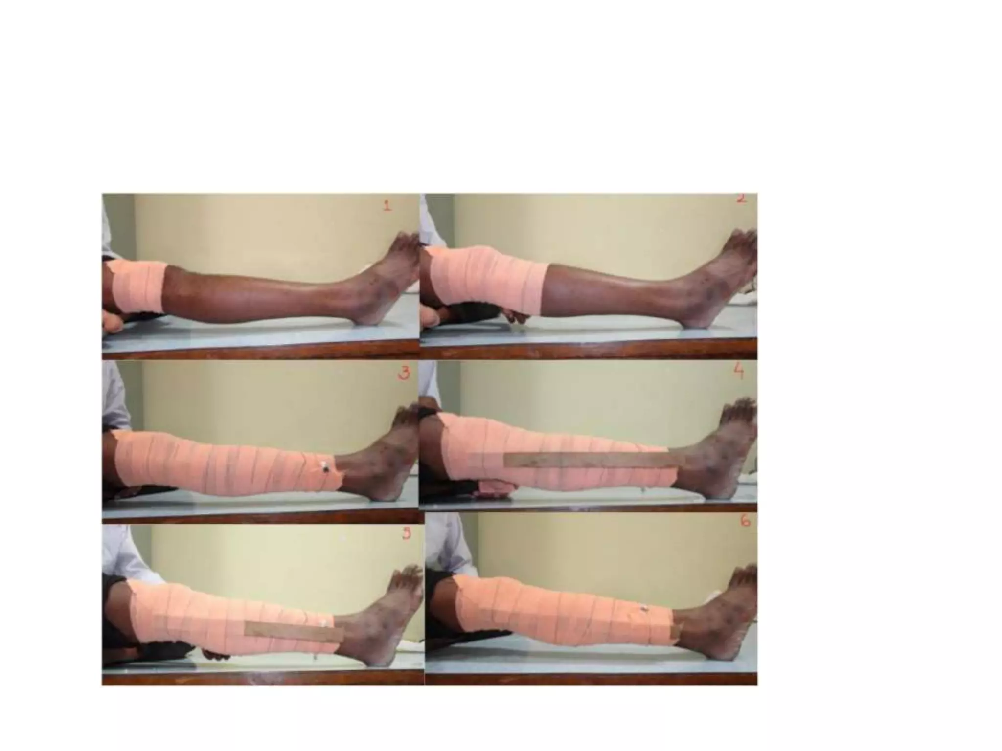 Snake bite - ASV Protocols and Management - Antisnake Venom | PPTX