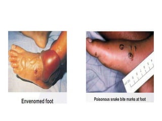 Snake bite - ASV Protocols and Management - Antisnake Venom | PPTX