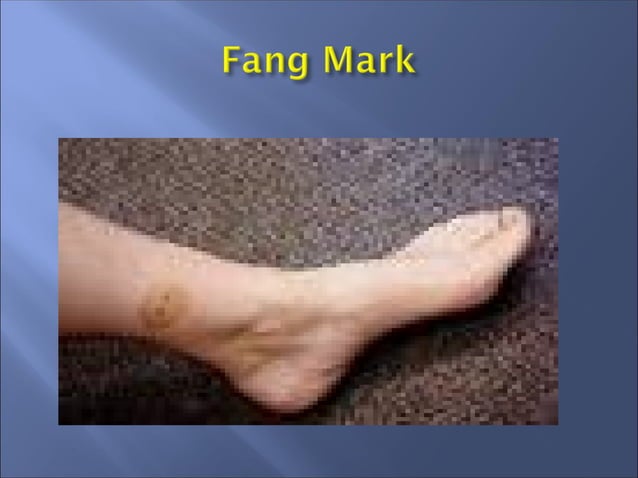 Snake Bite.ppt when a snake bites you what to do then | PPT | Blood ...